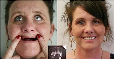 Woman Wakes Up From Surgery to Find Out That Dentist Has Removed All of ...