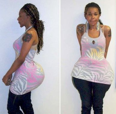 Graphic Content: Butt & Boob Implants Gone Horribly Wrong