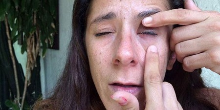 Woman Left With Stuck Eyelids After Friend Mistakes Glue for Eye Drops ...