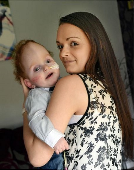 Touching Story of a Baby Boy Born With No Brain (Photos)