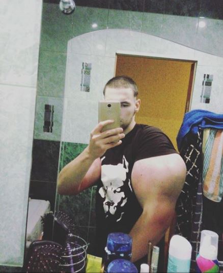 Unbelievable: 21-year-old Injects His Arms With Liters of Synthetic Oil ...
