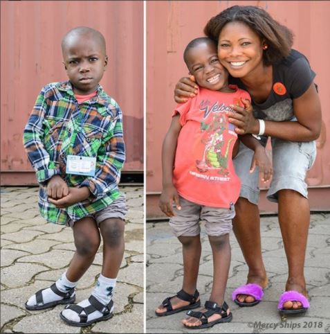 Excitement As Young Boy Undergoes Surgery To Correct His Windswept Legs ...