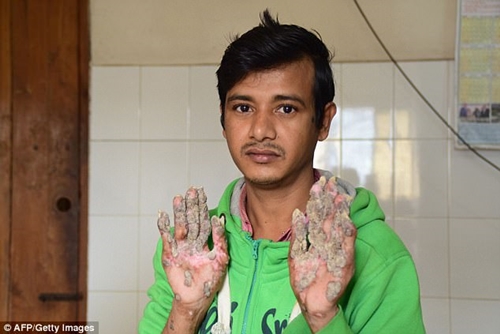 Meet The Man Called 'Tree Man' Whose Hands Grows Weird Trees (Photos)