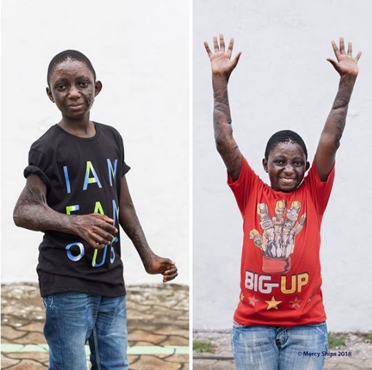 Free At Last: Young Boy With Locked Arms Finally Celebrates After ...
