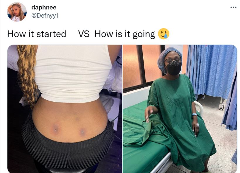 Lady Hospitalized After Getting A Back Dimple Piercing