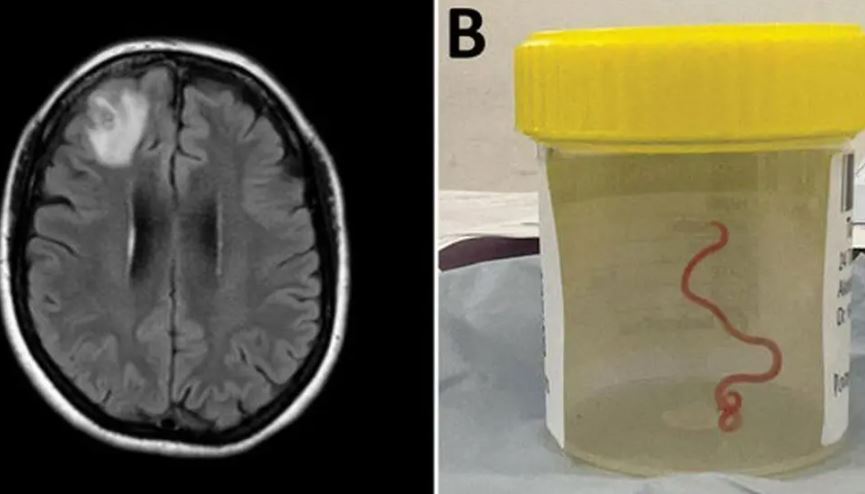 Live Worm Found In Australian Woman’s Brain