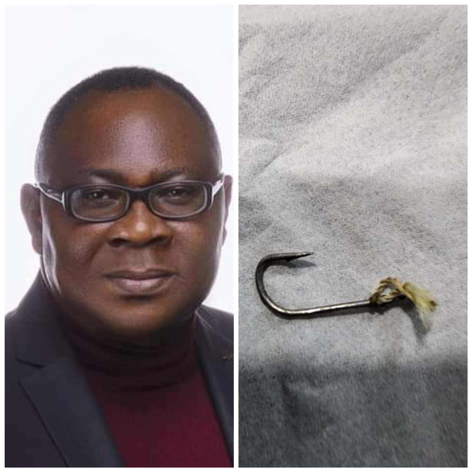 Very Scary - Nigerian Man Narrates How He Almost Swallowed A Metal Hook ...