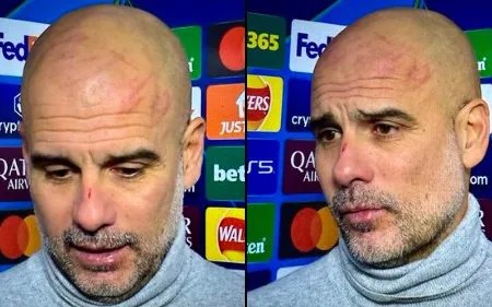UCL: I Want to Hurt Myself – Guardiola Explains Scratches On His Nose, Face