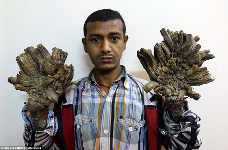 So Disturbing: Boy's Hands and Feet Turn to 'Tree Roots' in Shocking ...